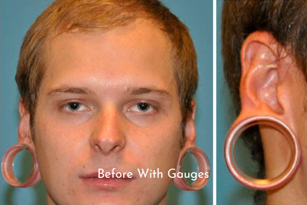 Ear Repair Piercings Ear Gauges And Damage Injury Barr Aesthetics