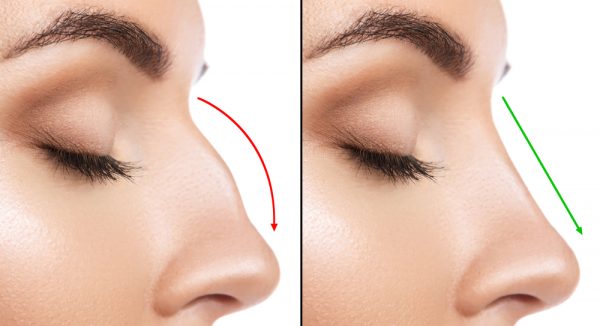 Nose Surgery Utah: Open Nose Surgeons | Barr Aesthetics