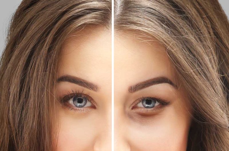 Exploring the Popularity of Cosmetic Eye Surgery | Barr Aesthetics